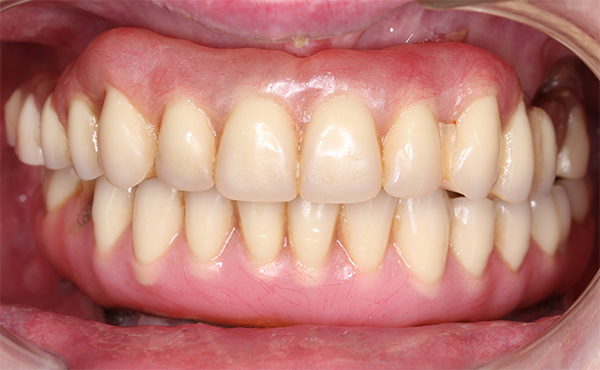Management of Technical Complications During Full-Mouth Implant ...