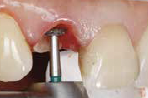 Guided Selective Preservation of Tooth (SPOT) Protocol: Fully Guided ...