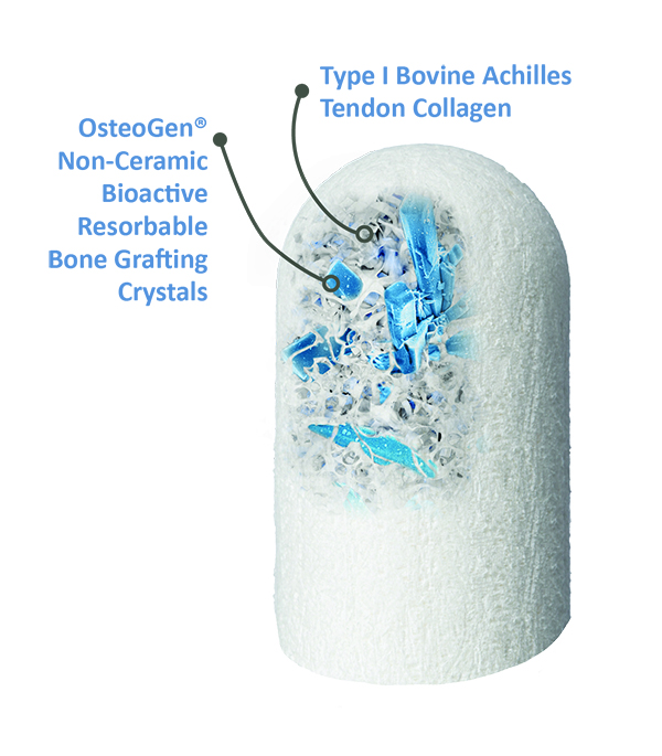 OsteoGen®: Simplicity, Consistency, and Predictability Is Formula for ...