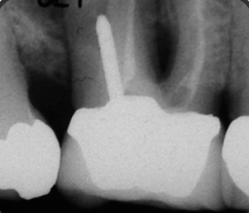 Redefining Perio Treatment With LANAP® and LAPIP™ Protocols | Compendium