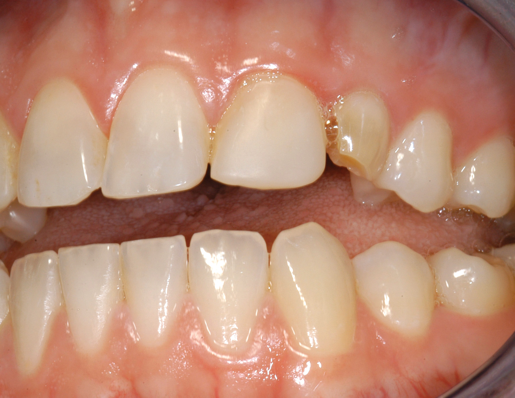 Case Report: A Multipronged Approach to Optimizing Anterior Implant ...