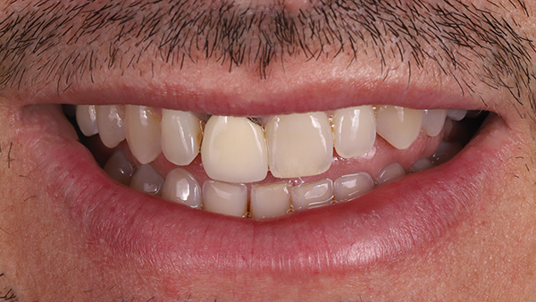 The Art of Saving Teeth: Restoring a Central Incisor With a New Post ...