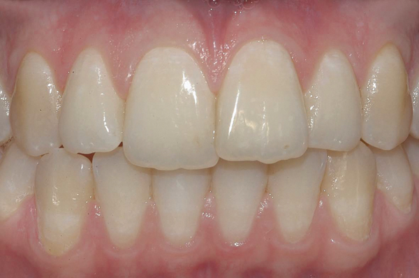 Lingual Orthodontics: Accelerated Realignment of the “Social Six” with ...