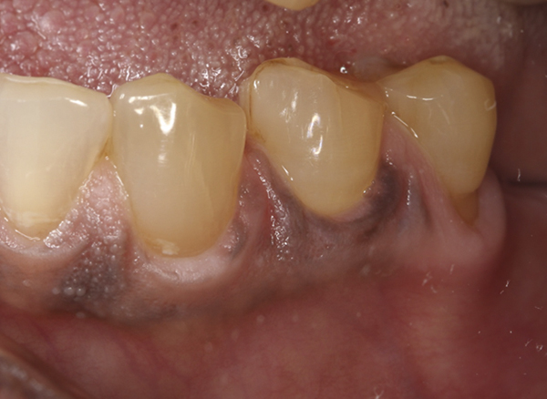 Managing a Lateral Periodontal Cyst With Bone Graft:A Computed ...