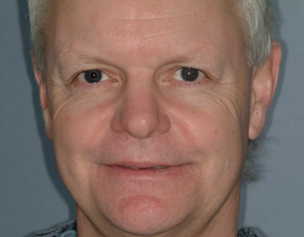 Bone Vs. Bite: Correcting a Dental Cross-Bite Using a Kois Deprogrammer ...