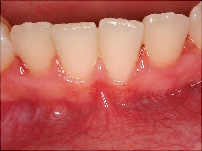 An Alternative Donor Site for an Epithelialized-Free Soft-Tissue ...
