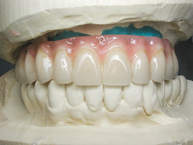 The Screwless Fixed Restorative System: Laboratory Perspective | Compendium