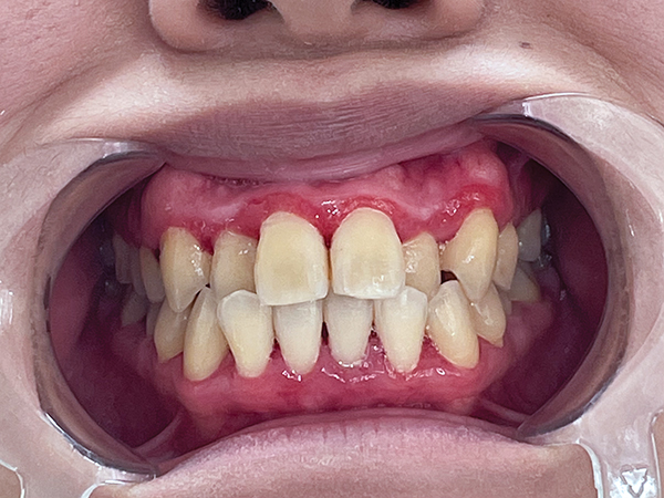 Clear Aligners Achieve Moderate to Severe Anterior Cross-Bite ...