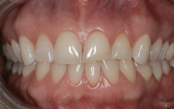 Occlusal Diagnosis and Treatment Provide the Foundation for Successful ...