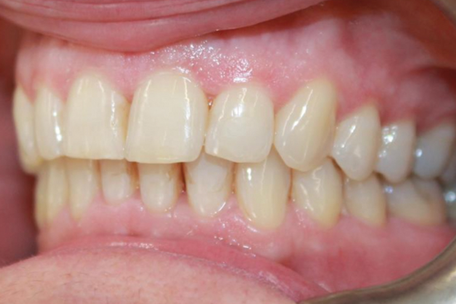 Treatment of Class II Malocclusion With Clear Aligners and Auxiliaries ...