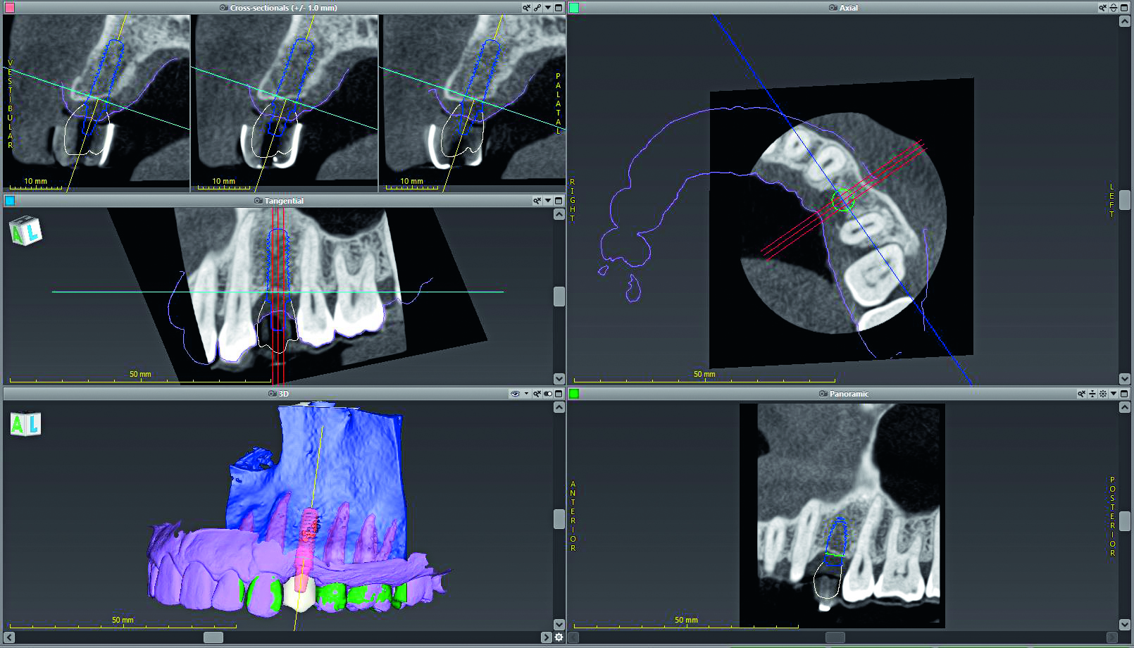Insertion of a Straumann® PURE Ceramic Implant Through the DWOS Synergy ...