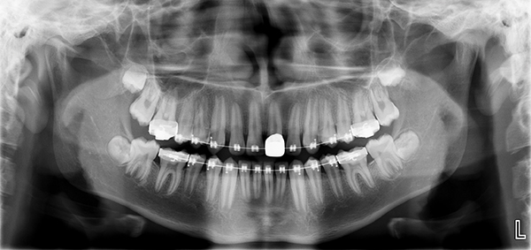 Unilateral Buccal Bifurcation Cyst: A Rare Cystic Lesion in Children ...