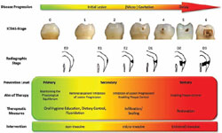 Caries Infiltration With Resins: A Novel Treatment Option for ...