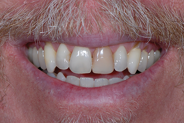 Gingival Margin Direct Restorations With Bioactive Enamel Composite ...