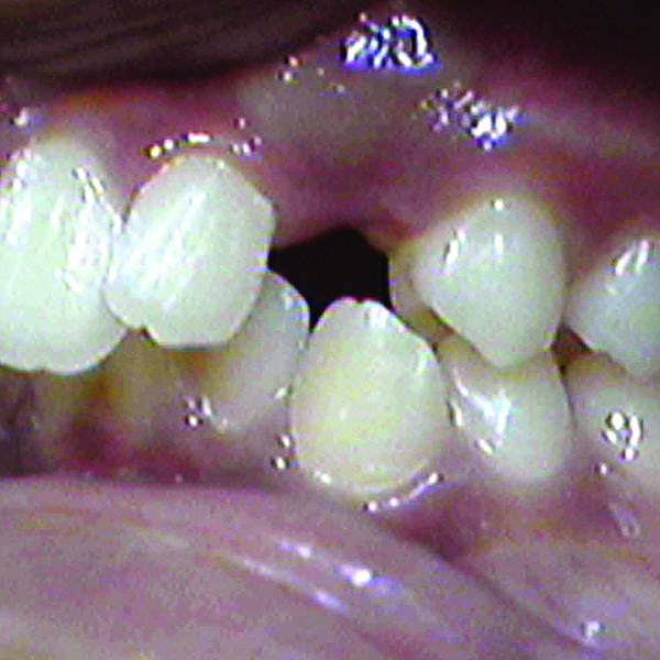 Periodontal Status Following Treatment of Impacted Maxillary Canines by ...