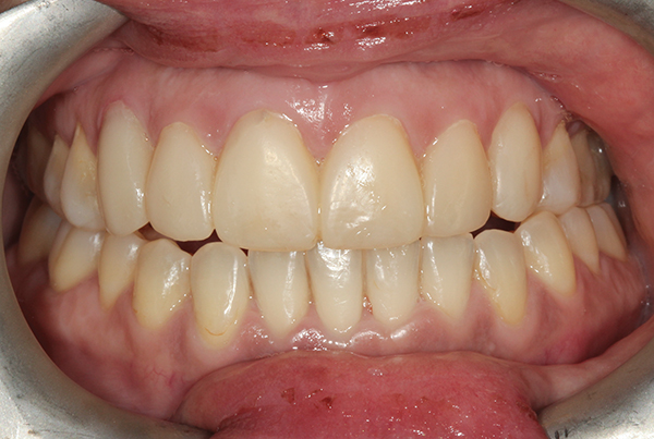 Creating Proper Occlusion With OccluSense® to Achieve Sound Function ...