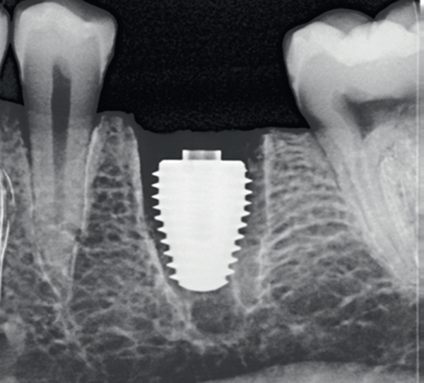 Ultra-Wide-Diameter Implants Gaining Favor for Immediate Placement in ...