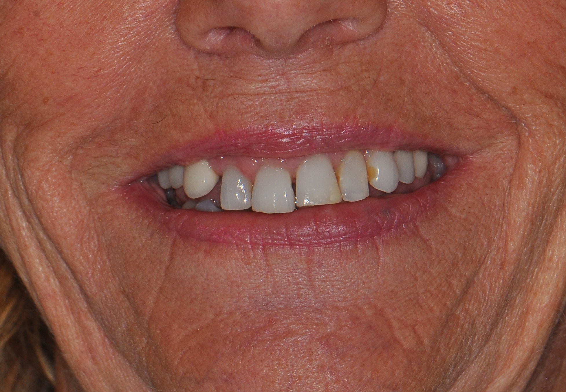 Team Approach in a Full-Mouth Pro Arch Hybrid Reconstruction Using the ...