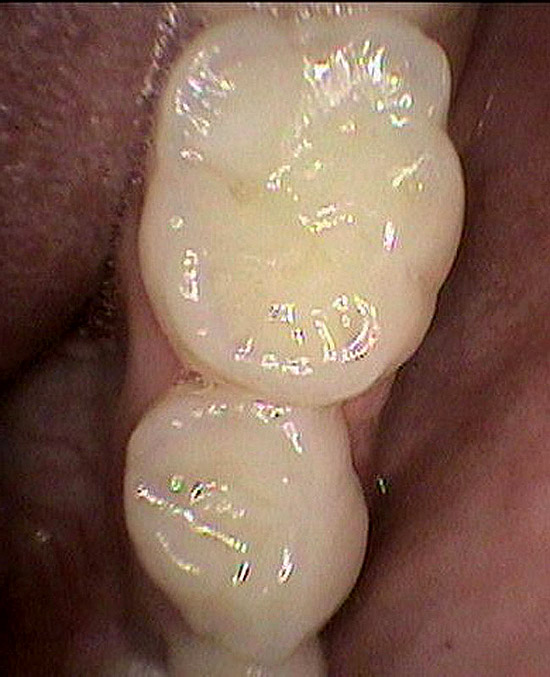 Additional Diagnostic Value of Digital Bitewing Radiographs in ...