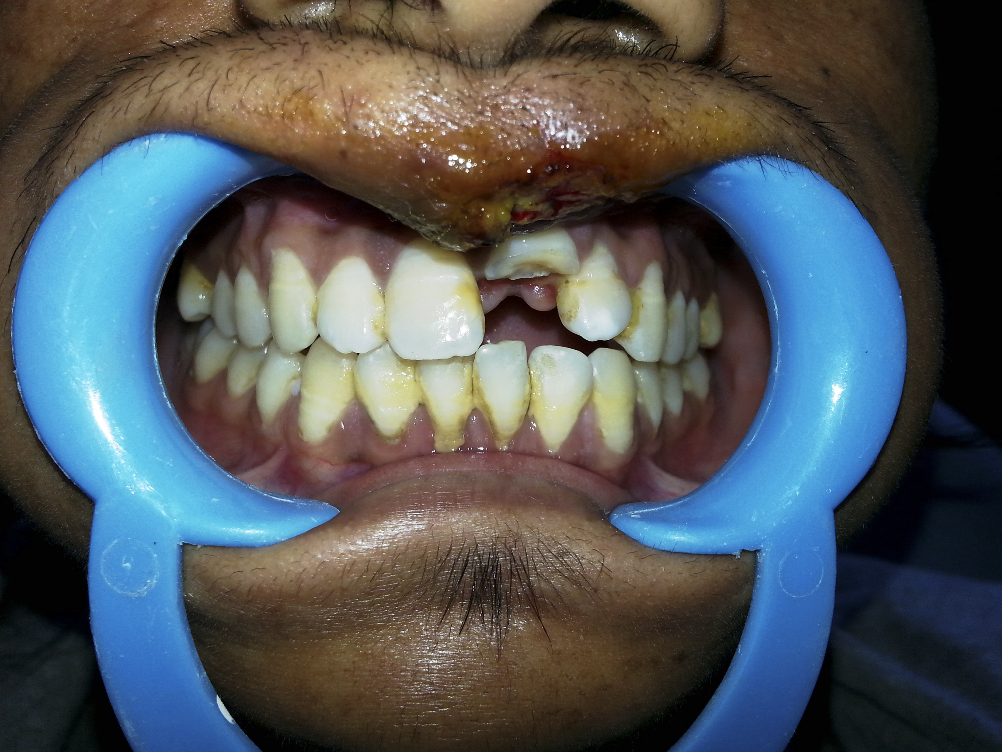CBCT-Aided Multidisciplinary Approach to Salvaging an Intruded Tooth ...