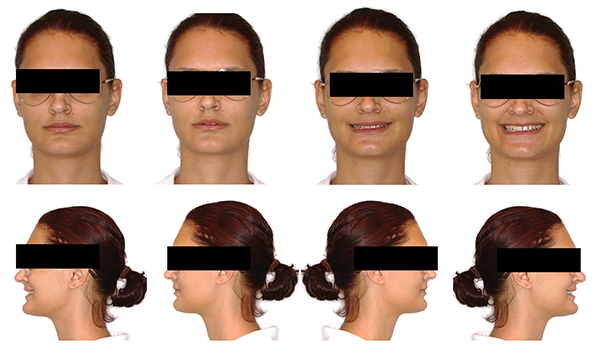 Minimally Invasive Ceramic Restorations: A Step-by-Step Clinical ...