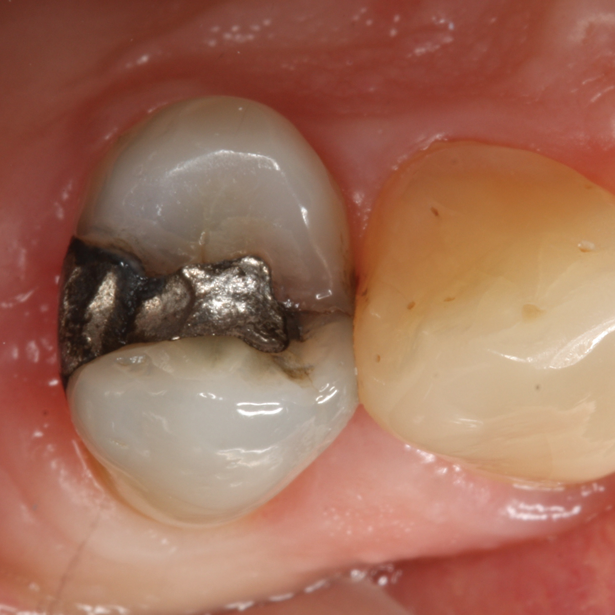Retrofitting a Crown Supporting a Removable Partial Denture Using ...